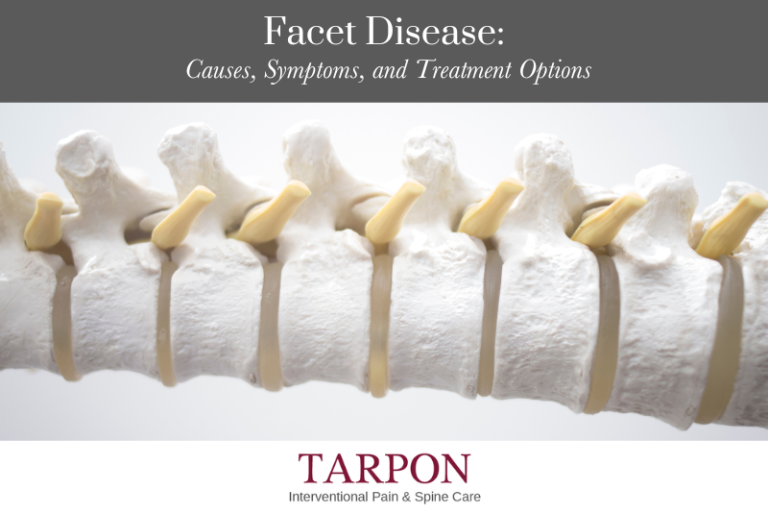 Facet Disease: Causes, Symptoms, and Treatment Options | Tarpon ...