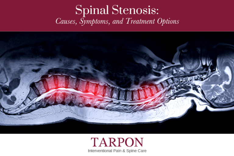 Spinal Stenosis Causes Symptoms And Treatment Options Tarpon 2323